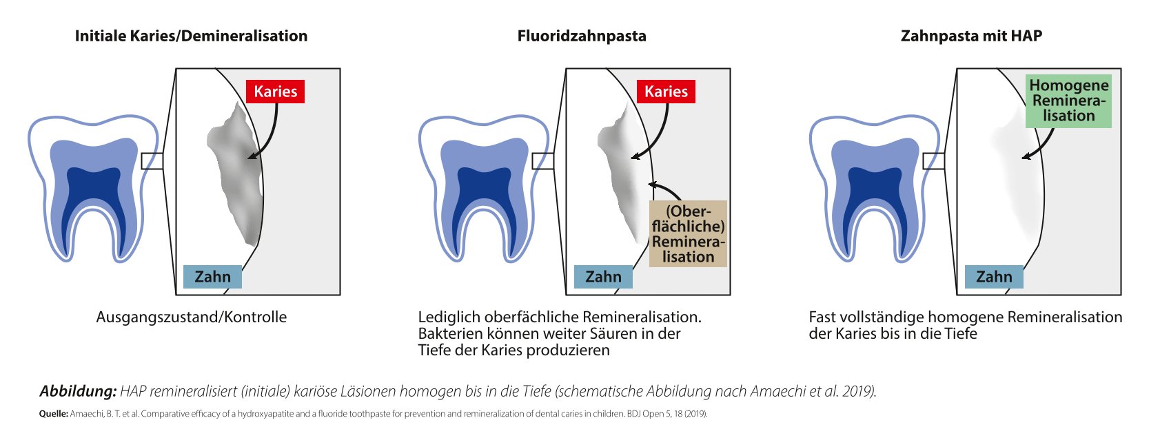 Langzeitstudie: Hydroxylapatit in der Kariesprophylaxe wirksam - Dr ...